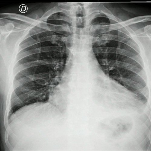 Paciente masculino de 62 años con derrame pleural y pericárdico ...